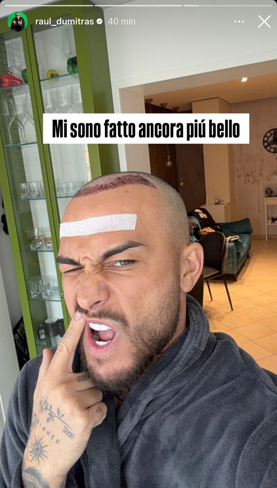 Temptation Island, Raul Dumitras si è sottoposto al trapianto di capelli