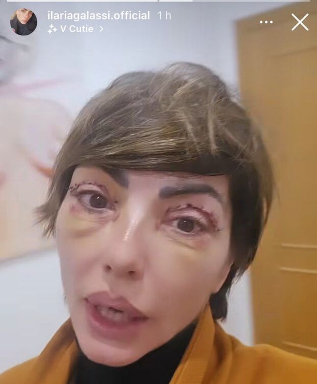 Gf Vip, Ilaria Galassi si mostra sui social dopo un intervento estetico ...