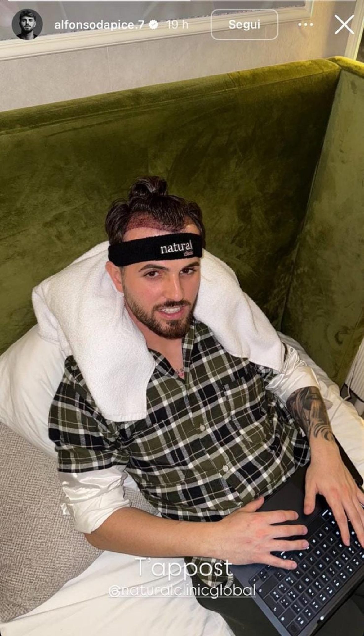 Grande Fratello, Alfonso D'Apice si è sottoposto al trapianto di capelli